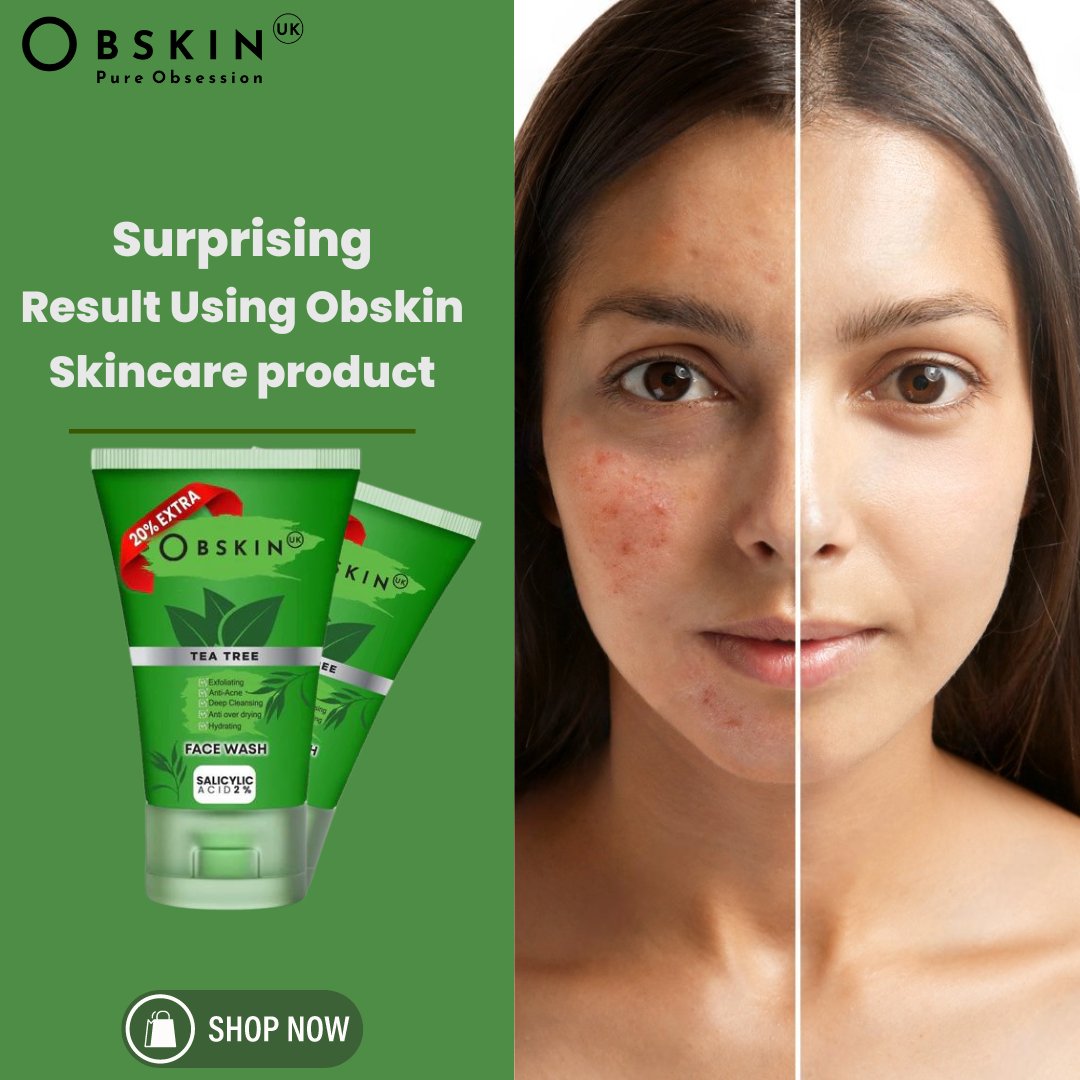The Ultimate Guide To Managing Acne Prone Skin Effective Solutions Wi